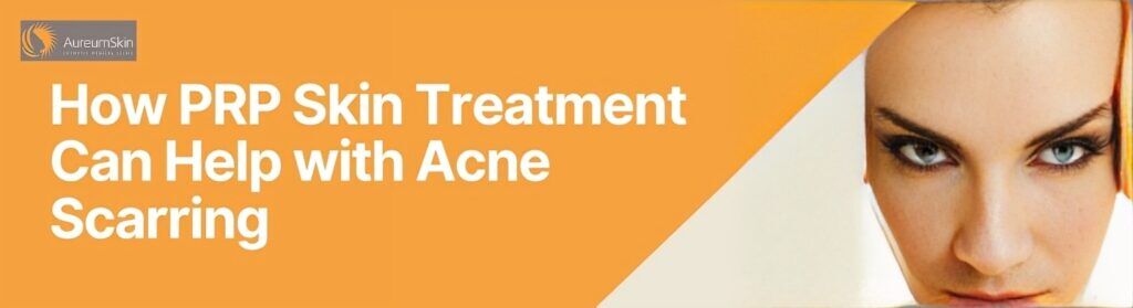 How PRP Skin Treatment Can Help with Acne Scarring | Aureum Skin