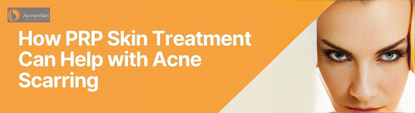 How PRP Skin Treatment Can Help with Acne Scarring | Aureum Skin